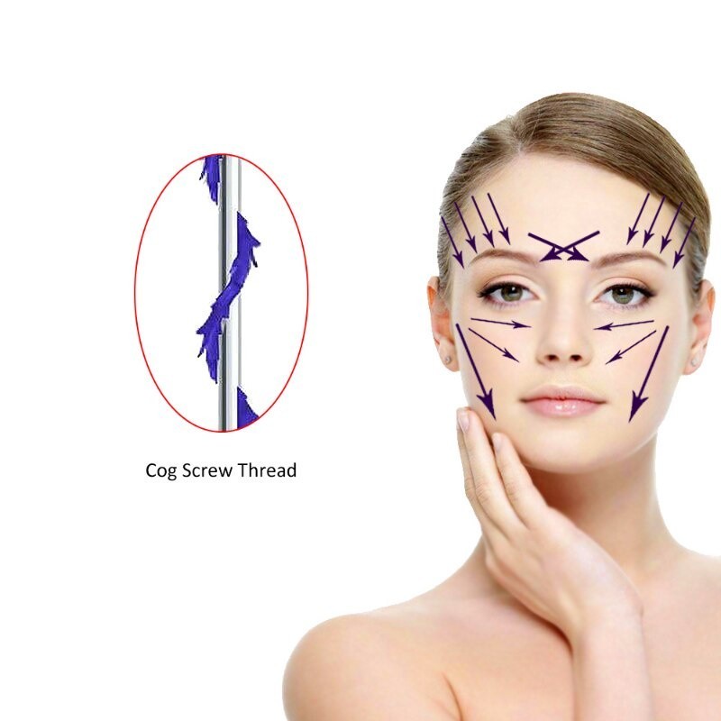 MINERVA PDO/PCL Thread 21g60mm Cog Fox Eye Jaw Line Face Lifting Cog ...