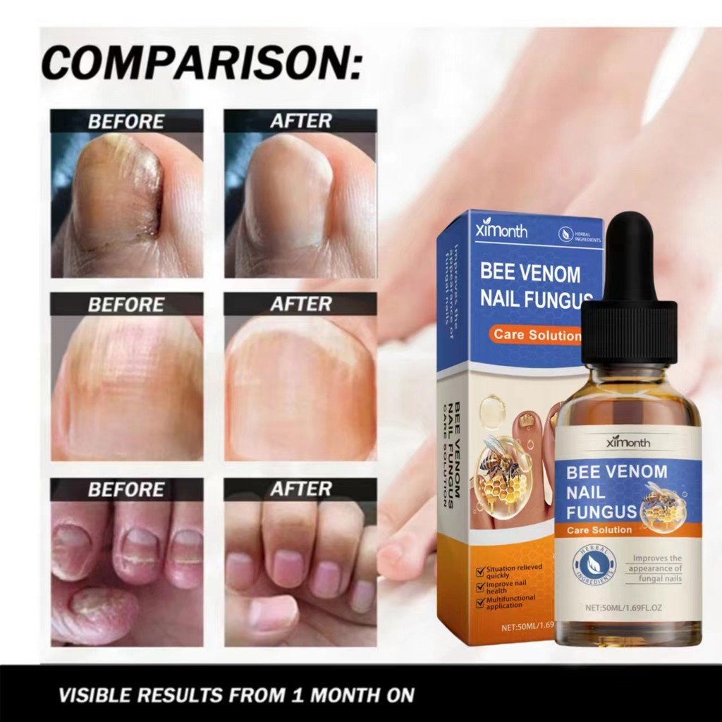 Nail Fungus Treatment, Best Nail Repair, Stop Fungal Growth, Effective ...