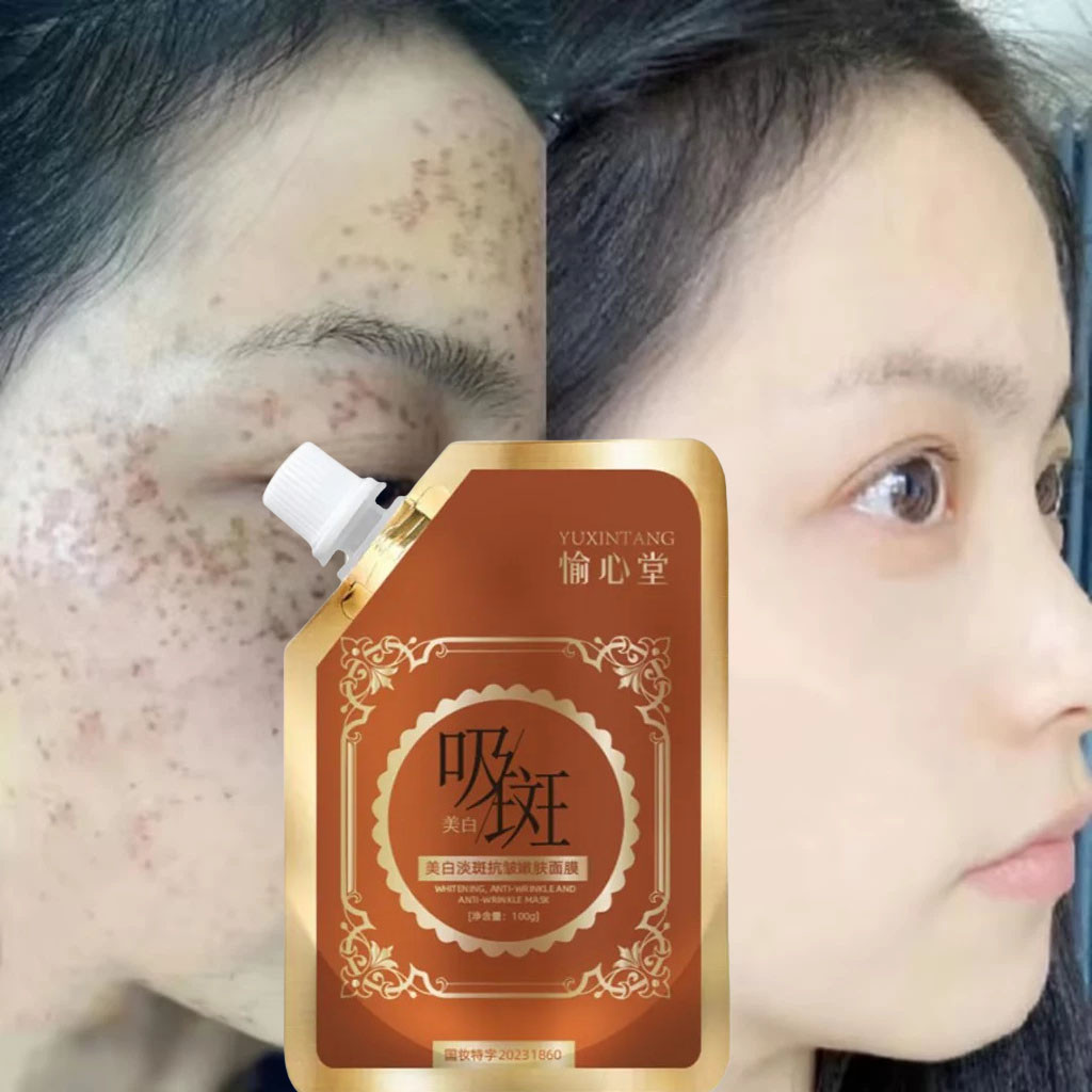 Melasma Removal Pekas Remover Original Pekas & Freckles Remover Cream ...