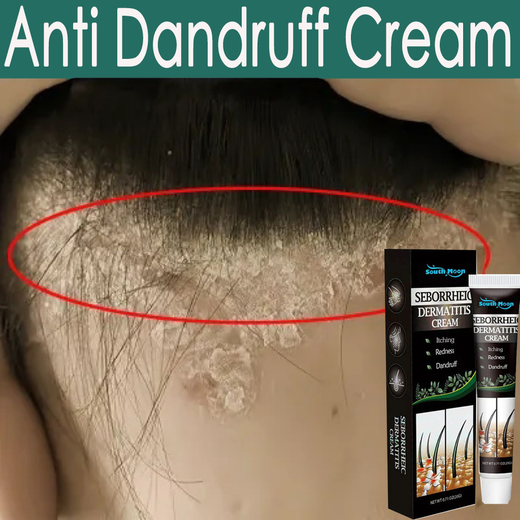 Anti Dandruff Cream for Scalp Itching and Dandruff for Men/Women ...