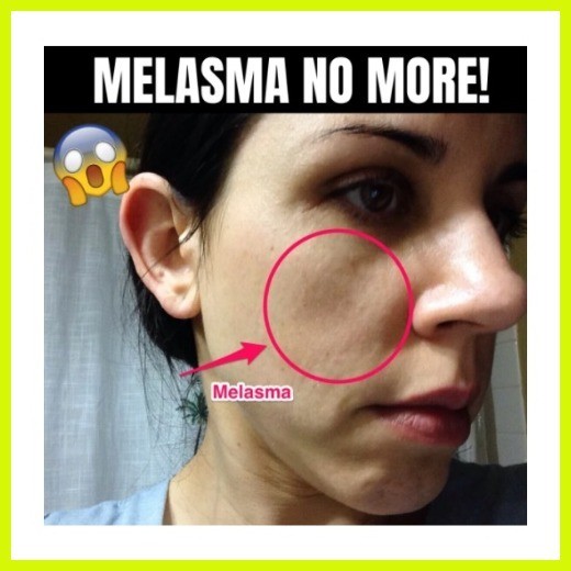 ♞Anti-Melasma Lightening & Skin Perfecting Cream Pekas Remover Remover ...