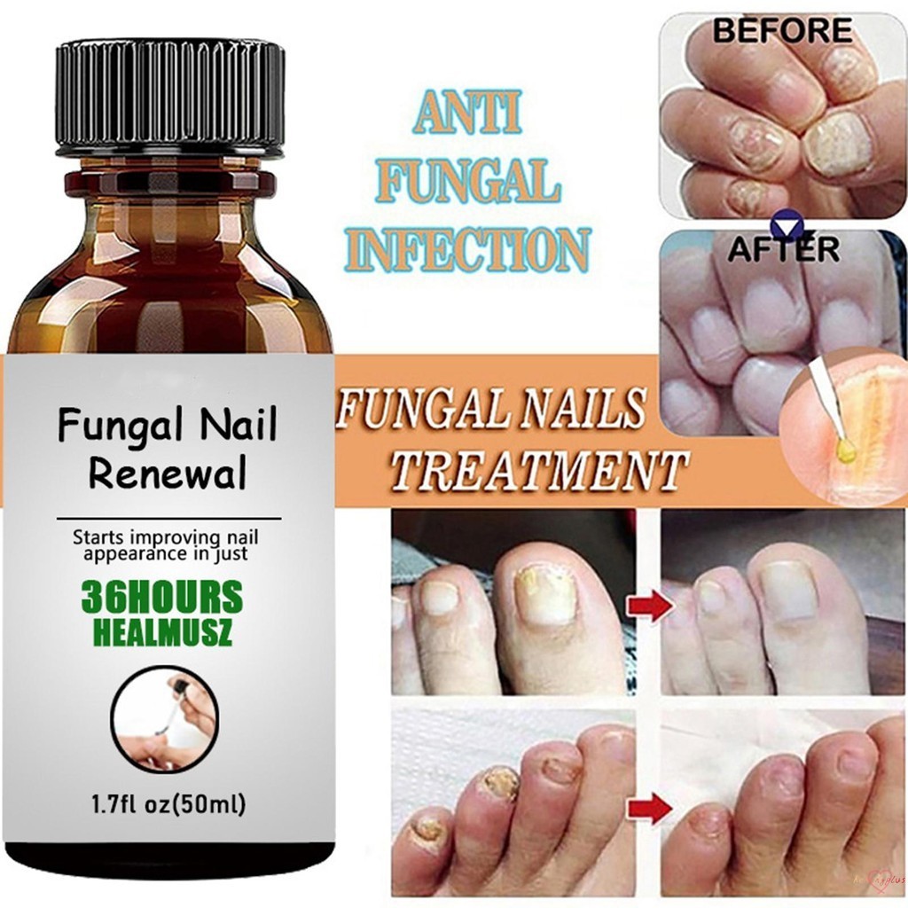 Nail Ingrown Repair Solution Anti-Infection Onychomycosis Paronychia ...
