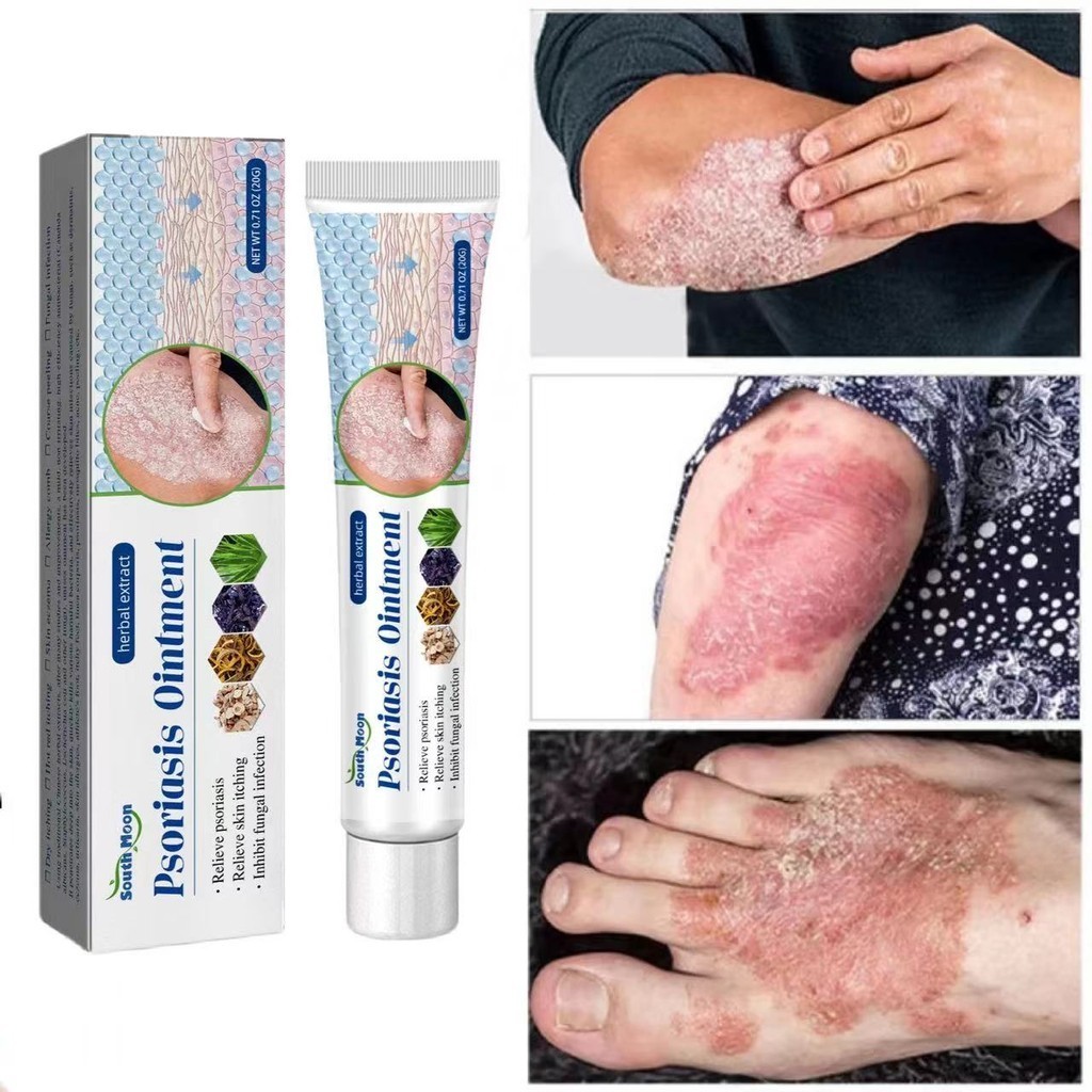 Psoriasis Dermatitis Eczema Pruritus Cream Ointment tanggal kati kati ...