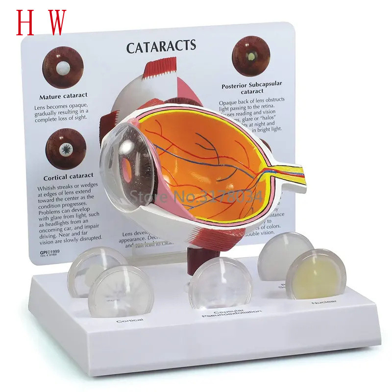 Human Cataract Eye Anatomical Model Body Anatomy Replica of Normal Eye ...