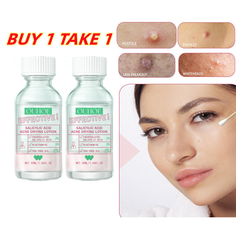 【buy 1 Take 1】salicylic Acid Anti Acne Serum Lighten Acne Scars Acne