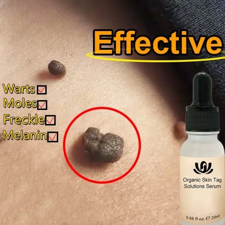 Warts Remover Serum Warts Remover Original Mole Remover Buni Removal By ...