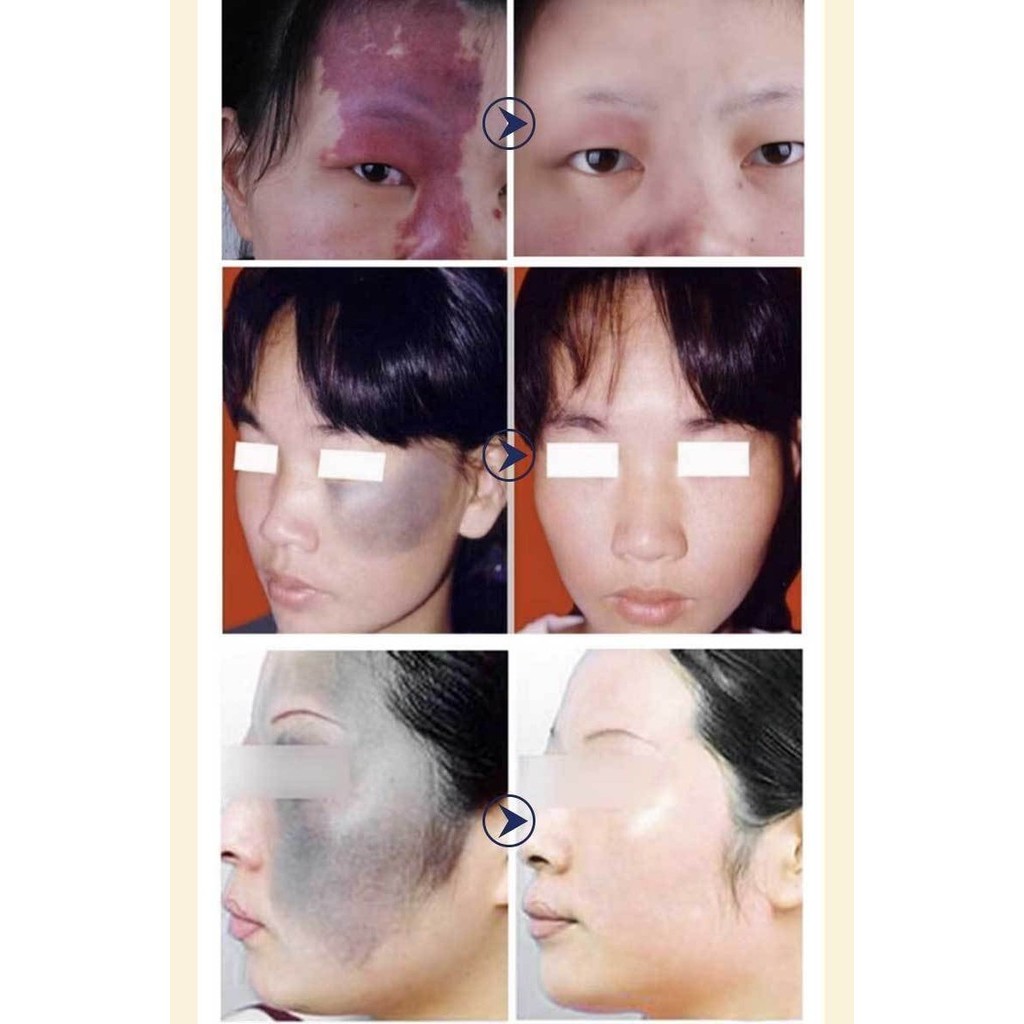 Xiaohongshu Recommended Natural Birthmarks Remove Melanin Remove Spots ...
