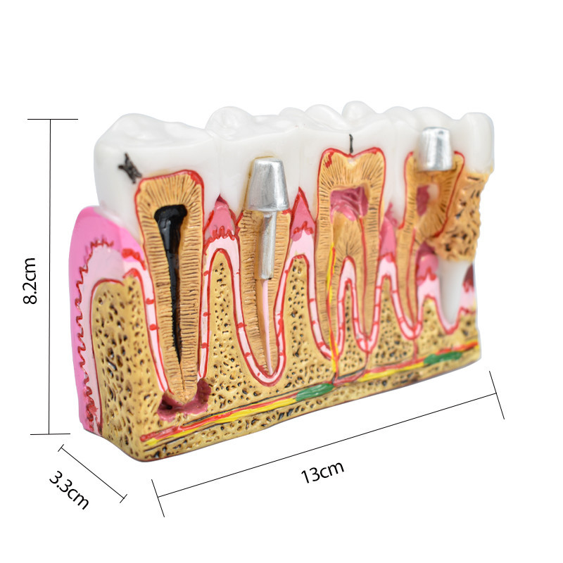 Dental Caries Anatomy Model Tooth Nerve Tooth Model for Oral Teaching ...