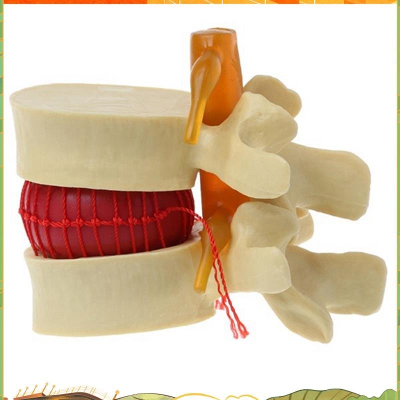 Lumbar Vertebrae Model Anatomical Spine Lumbar Disc Herniation Anatomy ...