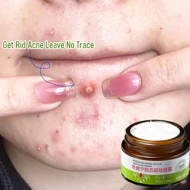 HIISEES Pionin Colloidal Sulfur Anti-Acne Cream 30g Oil Control Fade ...