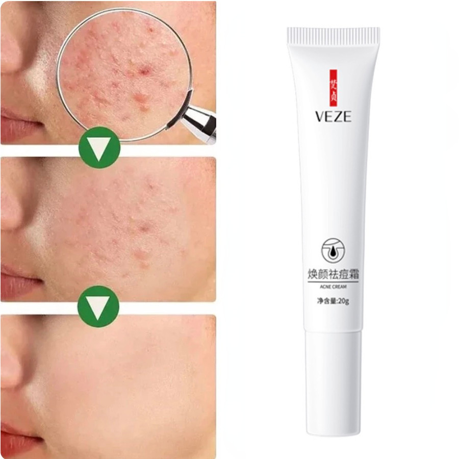 Anti-acne Cream Pore Shrink Oil Control Whitening Repair Pimple Deep ...