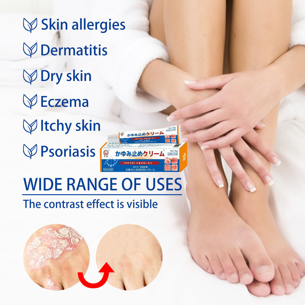 Japan Herbal Psoriasis Dermatitis Eczema Pruritus Cream Original for Skin Itching Treatment ...