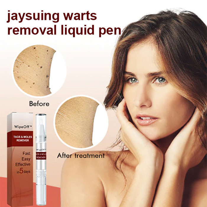 Wart Removal Liquid Pen Flat Plantar Warts Mole Dotting Liquid Pen ...