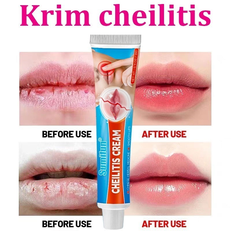 Cheilitis Lip cream moisturizing moisturizing Lips Skin Inflammation In The Lip area herpes On ...