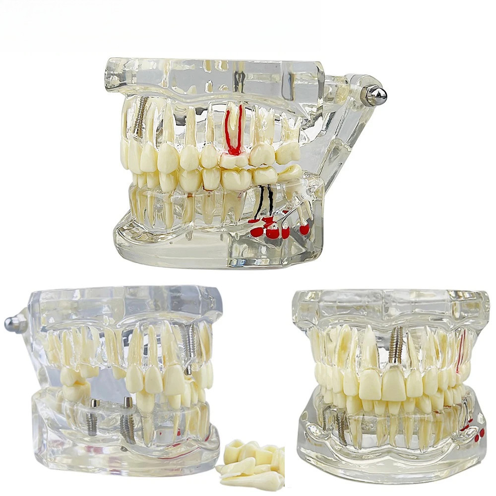 Teeth Model Implant Disease Dentist Studying Model With Restoration ...