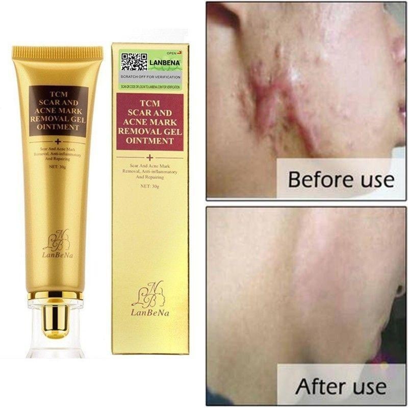 RQ+AURTHENTIC LanBeNa TCM Acne Scar Mark Removal Gel Ointment 30g &Z#W | Shopee Philippines