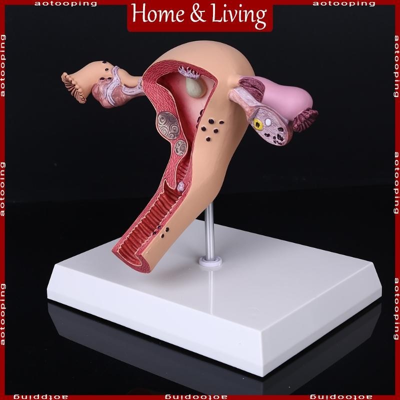 AOTO Human Female Uterus Ovary Disease Dissection Pathology Model Biology Teaching | Shopee ...