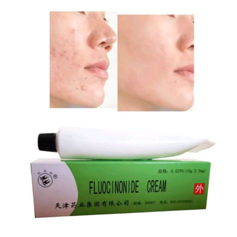 Fluocinonide cream Swallow Ointment anti-irritation Acne and Spot ...