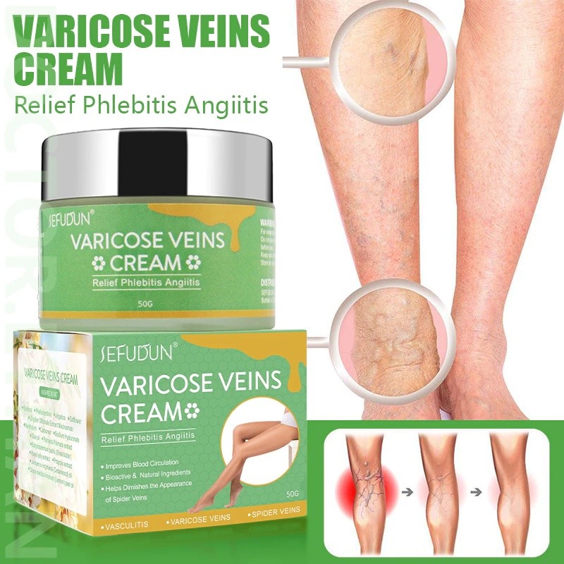 Varicose Vein Remover Spider Vein Pain Killer Cream ORIGINAL Effective ...