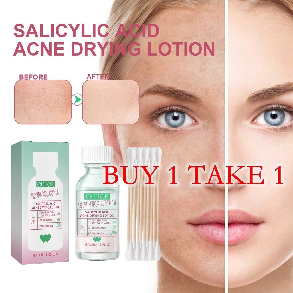 【BUY 1 TAKE 1】 Pimple Warrior Salicylic Acid Acne Drying Lotion - Acne ...