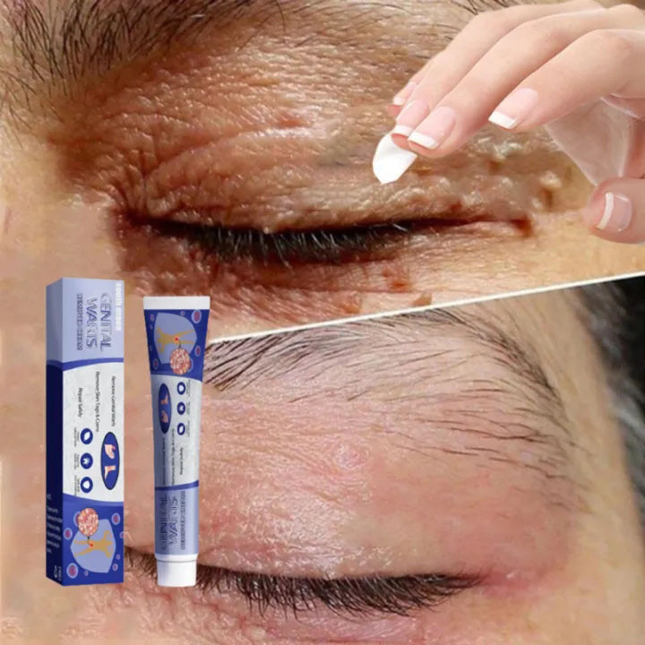 Original Painless Skin Warts Removal Pen Warts Mole Remover Gel Tag ...