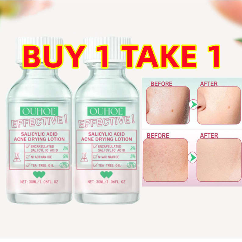 BNB Pimple Warrior Salicylic Acid Acne Drying Lotion Triple ...