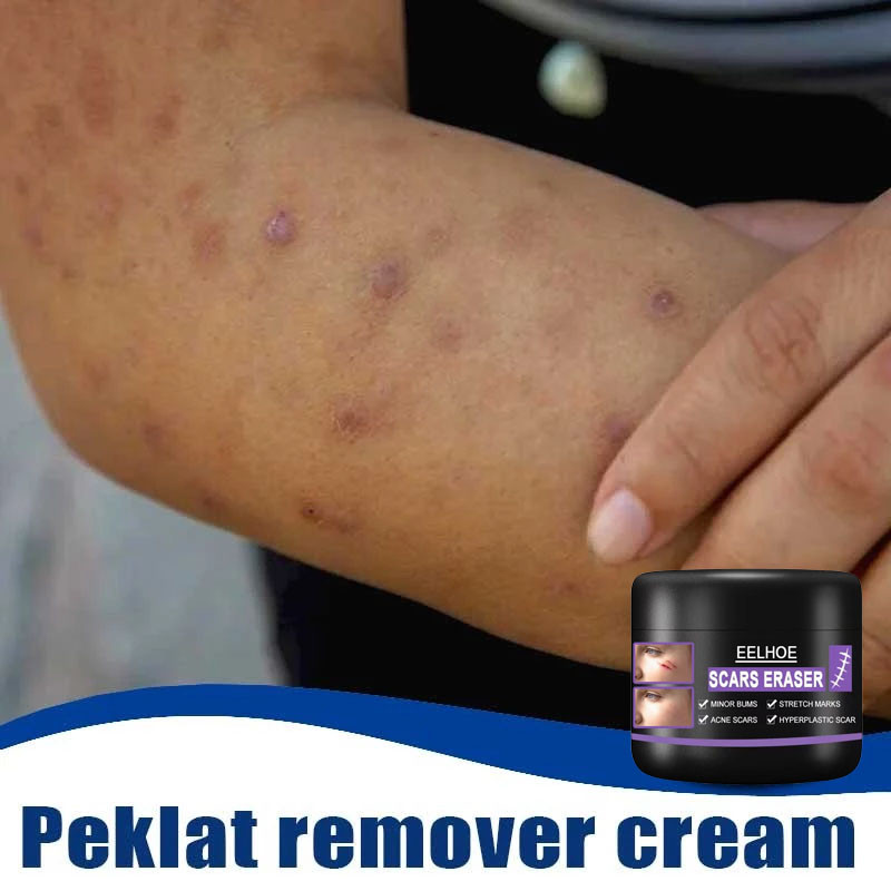 Scars remover peklat remover original scar cream removal for old scar ...