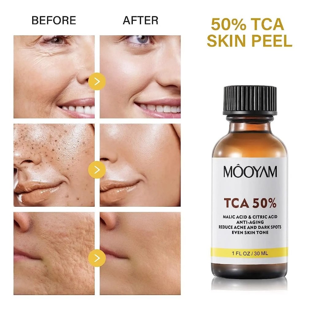 MOOYAM TCA 50% Peel Care Peeling Wrinkles Spots Skin Care Face Serum ...