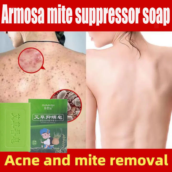 Remove Mites Soap Eczema Skin Repair Acne Psoriasis Seborrhea Anti ...
