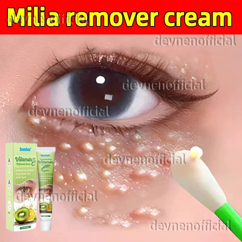 Milia Removal Eye cream, fat granules cream to reduce under-eye bags ...