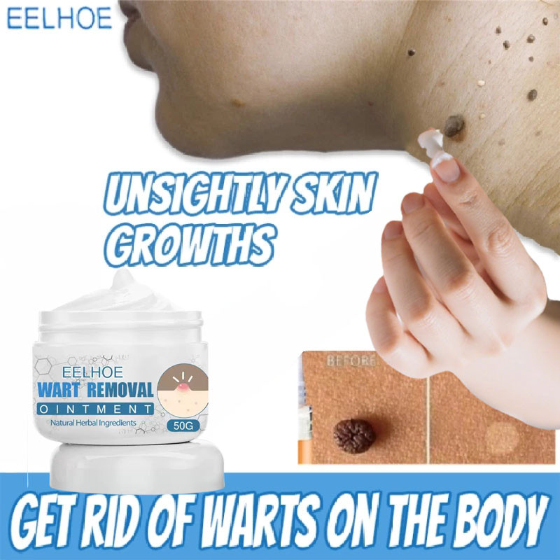 Original fast Warts remover Cream kasoy oil cream Kulugo mole skin tag ...