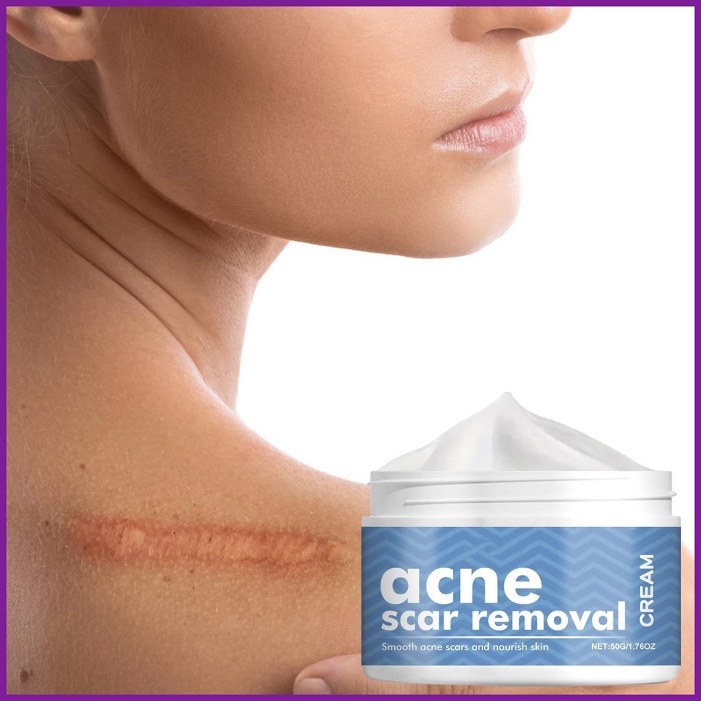 Acne Removal Face Cream Anti-Acne Gel Treatment Acne Scar Pimples Scar ...