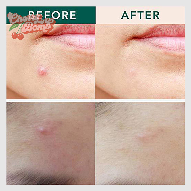 (Cherry Bomb) 6 Stickers Tiny needles Anti Acne Pimple Removal Soothing Skin Face Patches Master ...