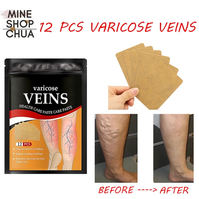 12pcs Varicose vein Remover patch pain relief body relief knee Patches ...
