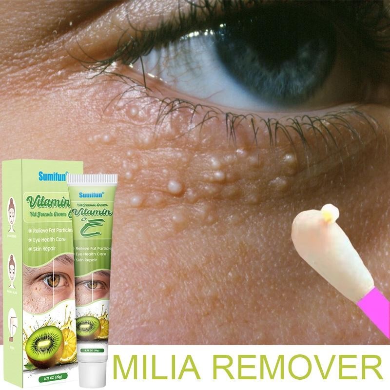 Eye Cream Krim Milia Seed Remover Eye Care Fat Granule Syringoma Milia ...