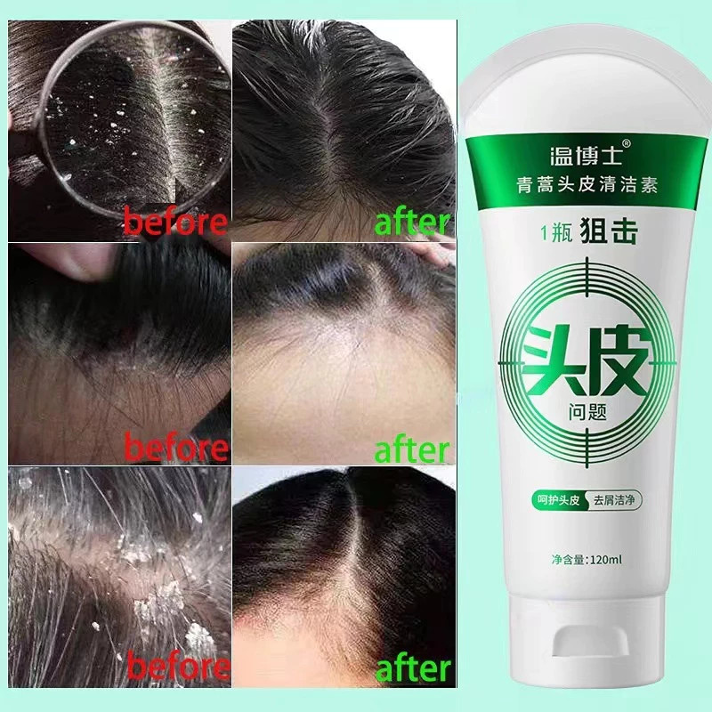 120ML Anti Dandruff Remove Mite Shampoo Hair Moisture replenishment ...