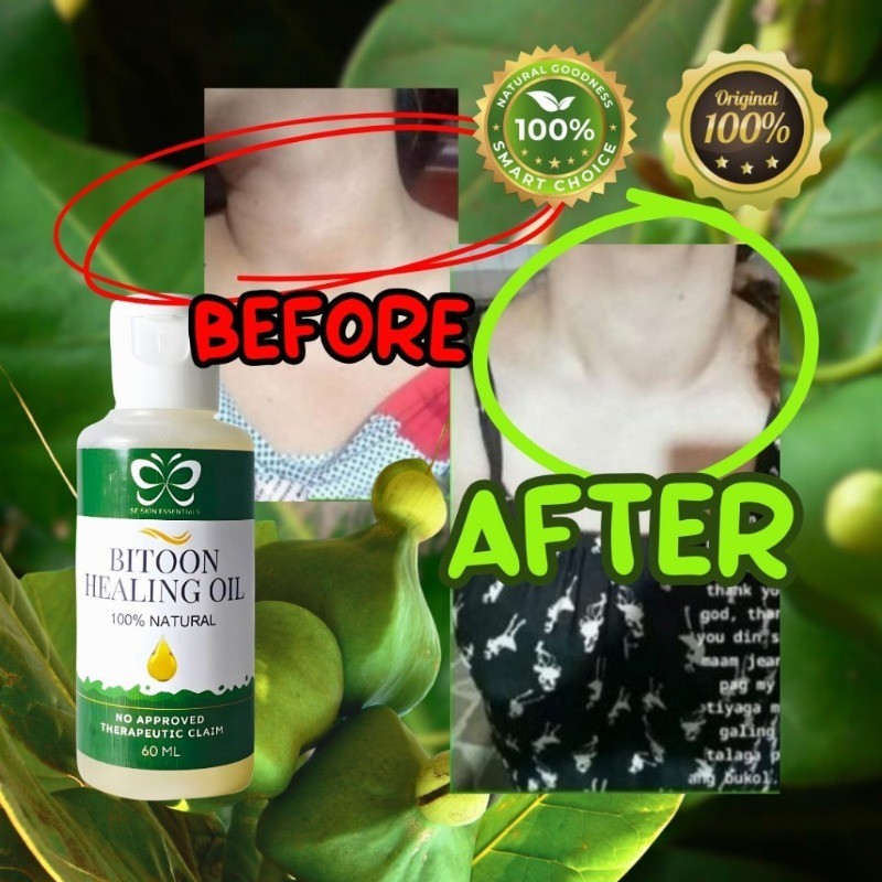 Effective Bitoon Healing Oil By SE Skin Essentials | Shopee Philippines