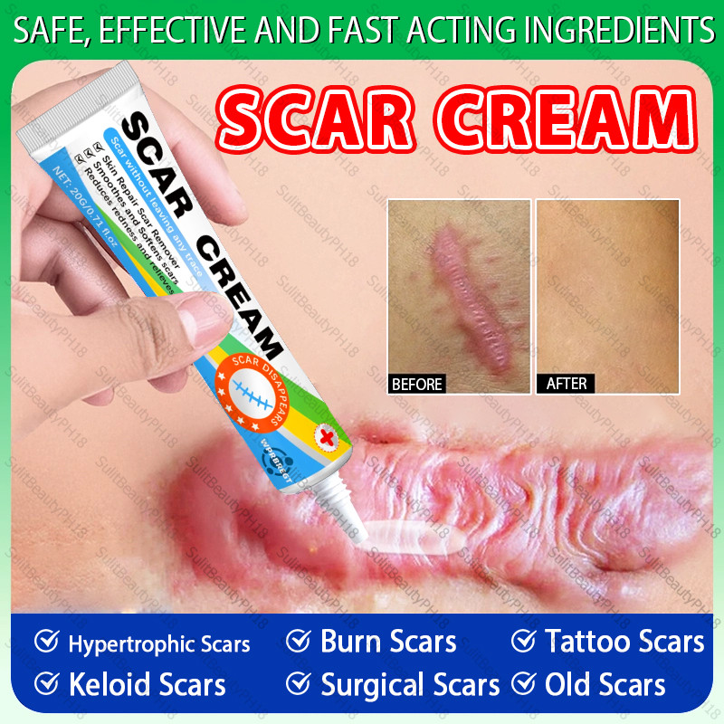 Scar Removal Cream,Advanced Scar Cream for Surgical Scars, Acne Scars ...