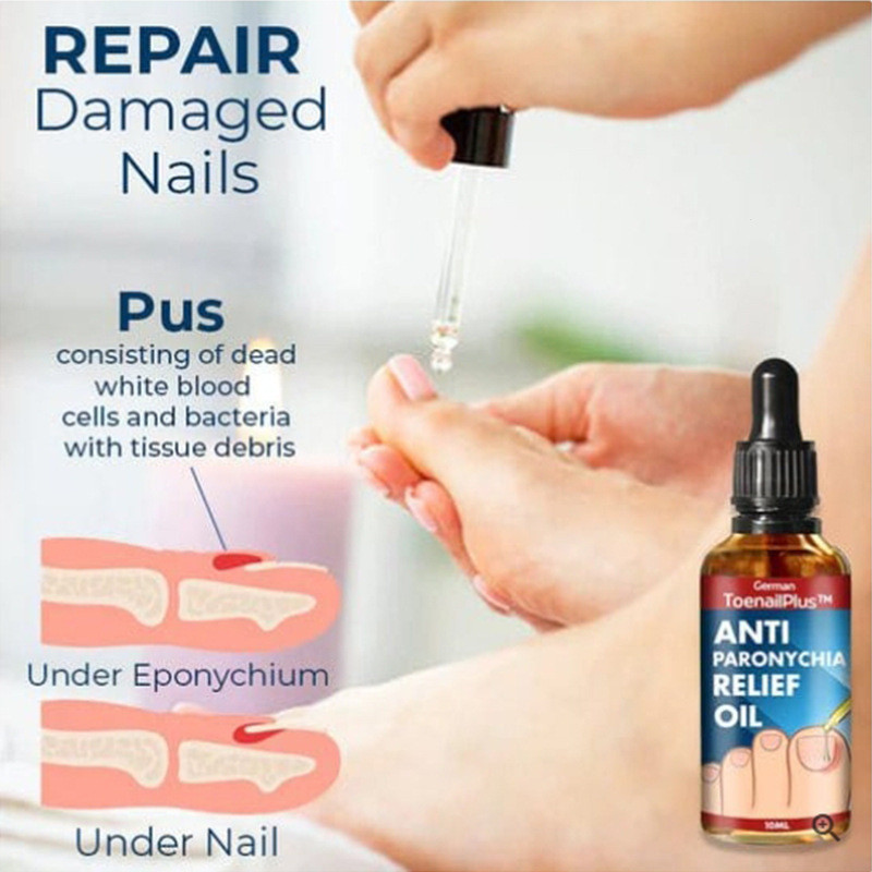 ingrown toenail nail fungus treatment ubat kuku cekam toenail corrector ...
