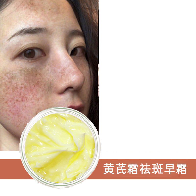 Whitening Freckle Removal Cream Light Chloasma Freckles Age Spots ...