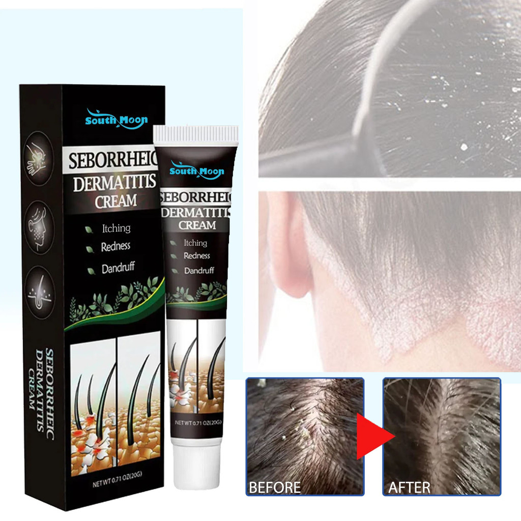 Anti-Dandruff Cream for scalp psoriasis Fluffy Hair dandruff treatment ...