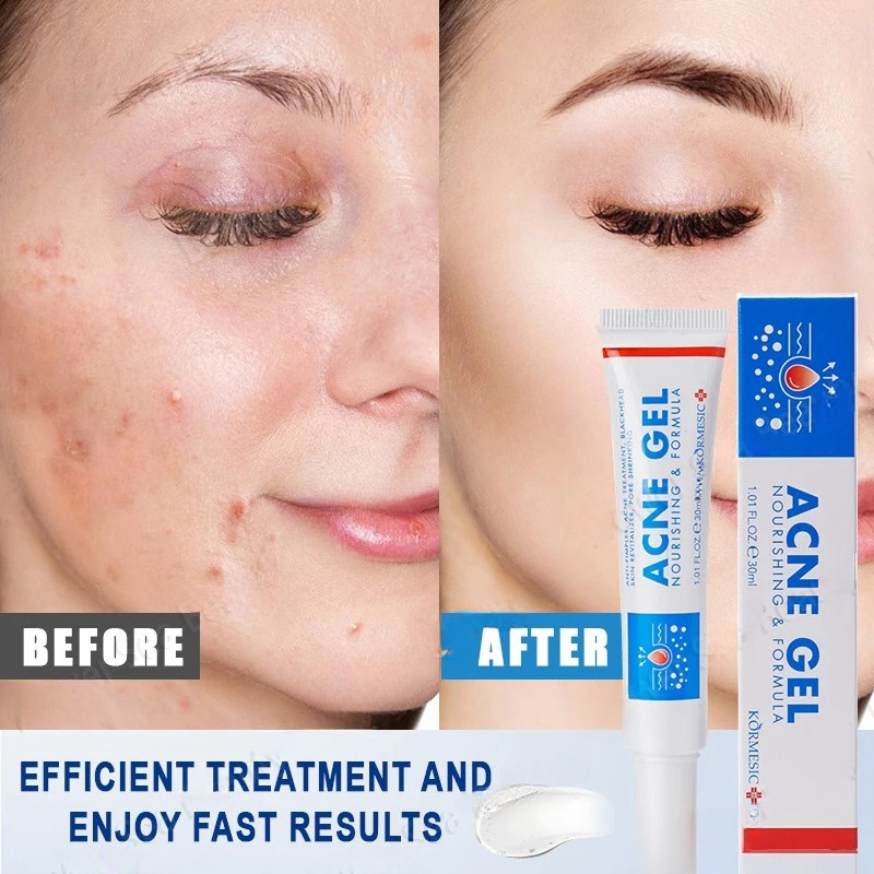 Acne Cream Remove Blackhead Oil Control Anti-Acne Treatment Repair ...