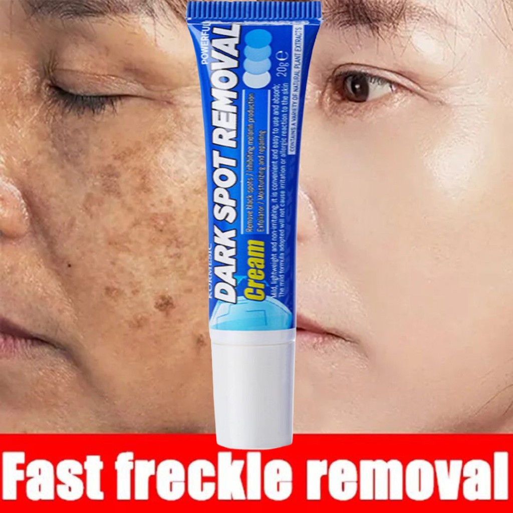 Pekas Remover Effective Melasma Cream Anti Freckle Collagen Skin ...