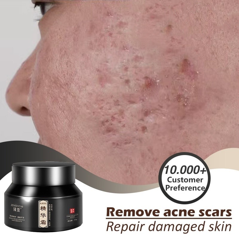 【in stock】Acne scar removal 50g Post-Acne Marks Removal Acne&Pimple ...