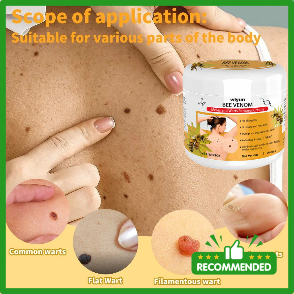 Bee Venom Cream Tag Recede Wart Remover Skin tag remover Ubat ketuat ...