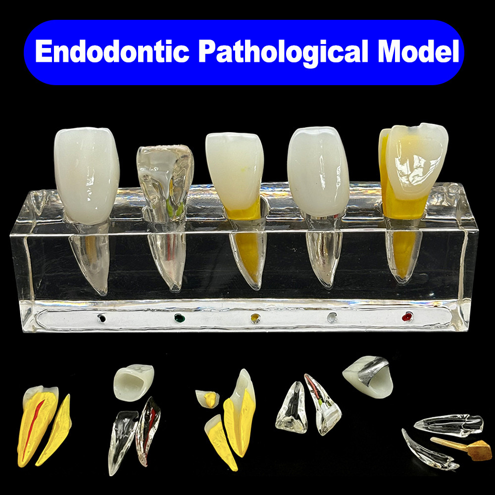 Dental Resin Teaching Model Endodontic Pathological Anterior Front ...