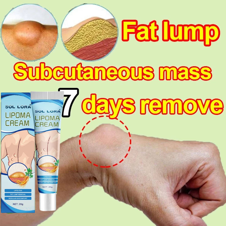 20g Lipoma Removal Cream Lipolysis Fat Lump Relief Plaster Skin ...