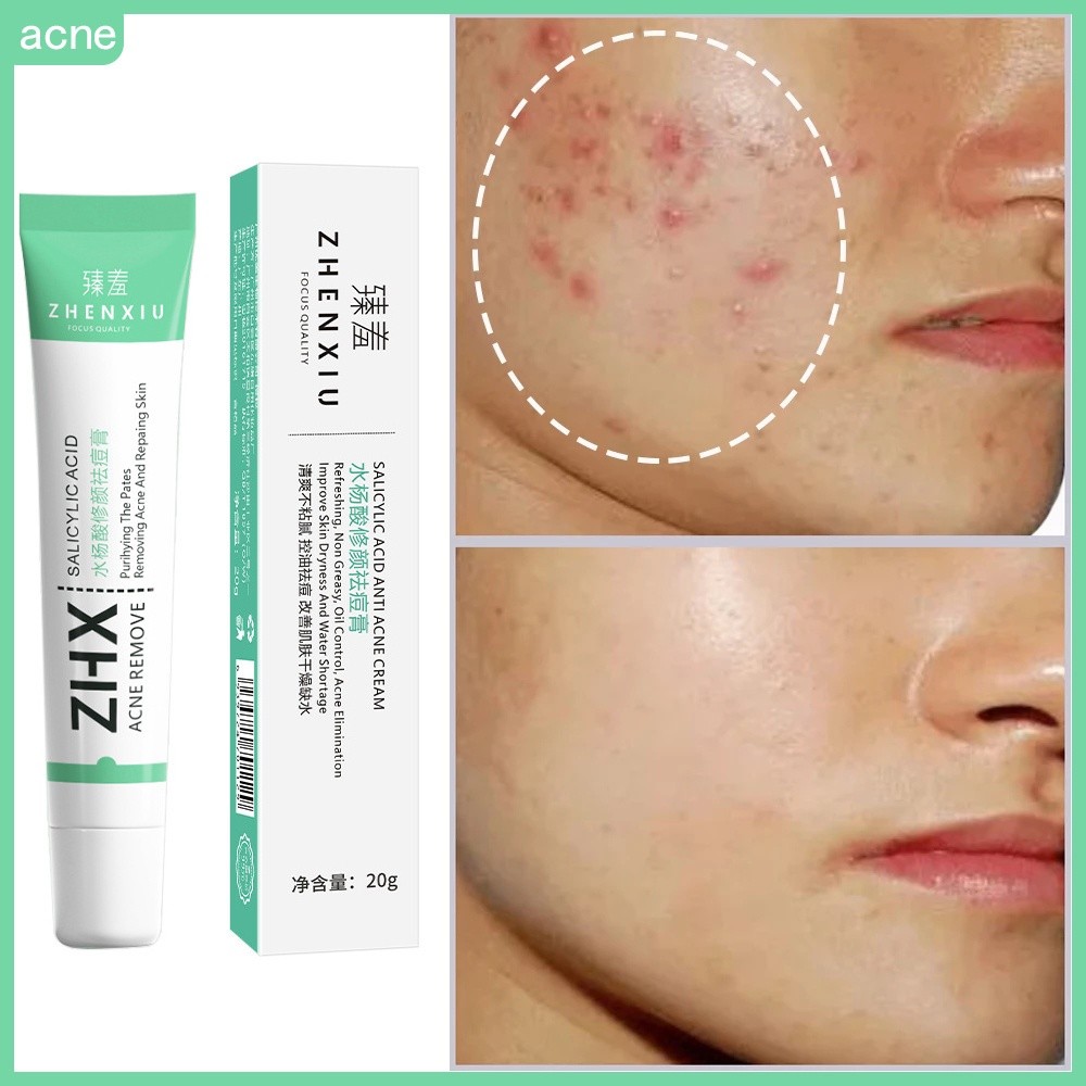 [ready Stock ]Salicylic Acid Acne Cream Remove Blackhead Oil Control ...