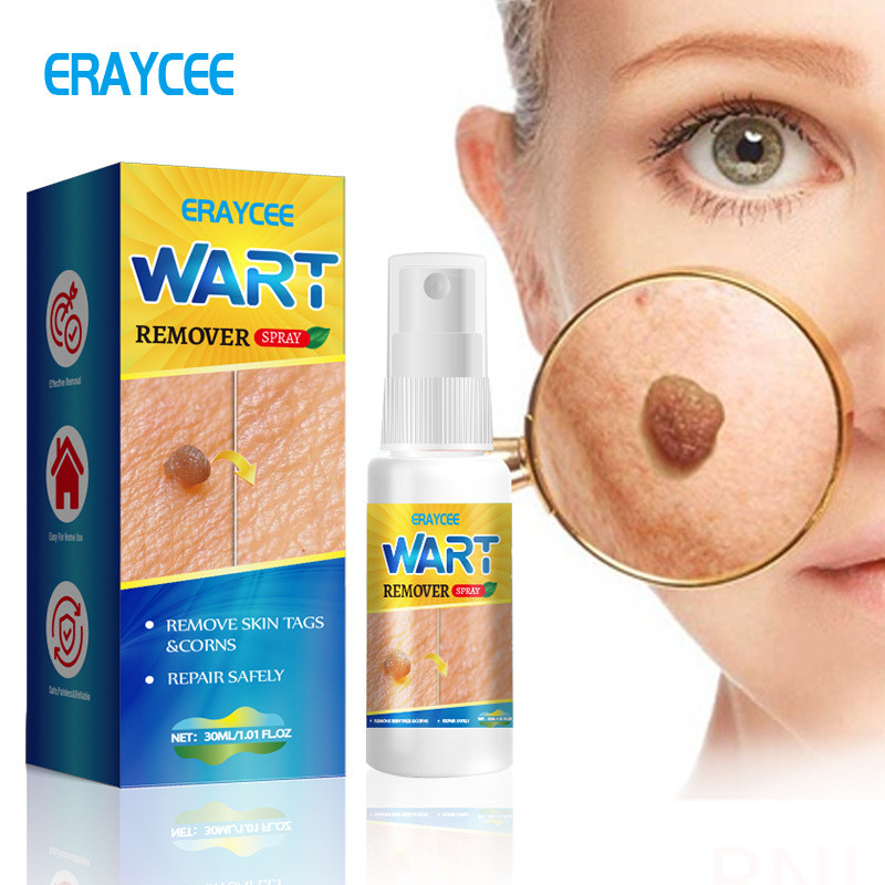 Verruca and Wart Remover - 30ml, Verucca Freeze Treatment for Effective ...