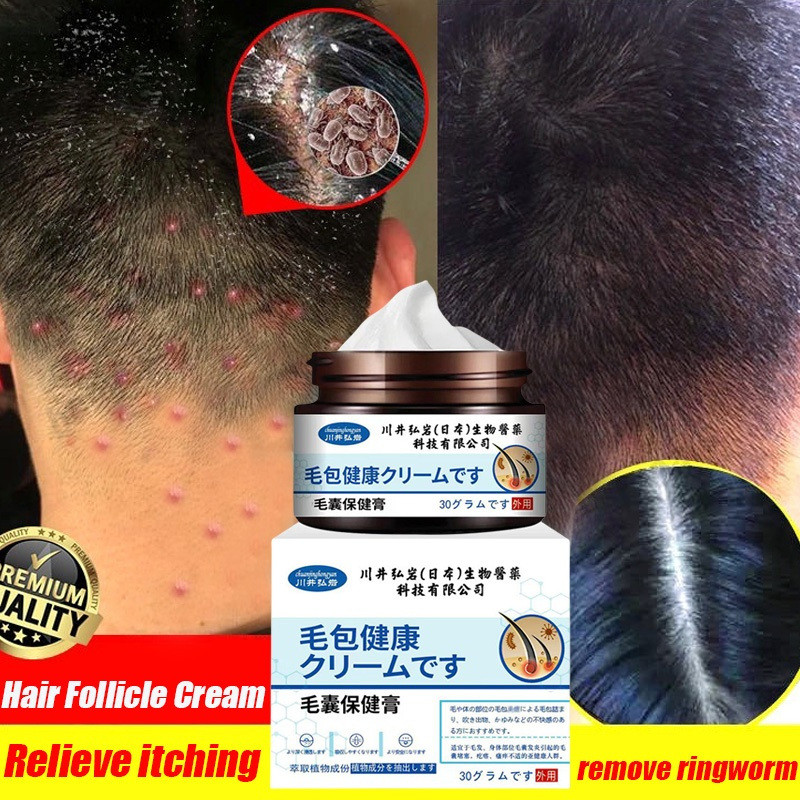 Seborrheic dermatitis cream Scalp acne treatment psoriasis Folliculitis ...